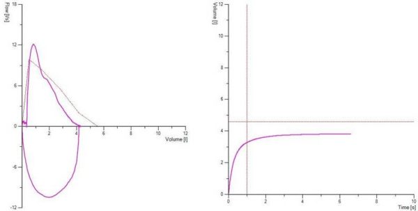 5 Common mistakes when performing Spirometry – Love Medical