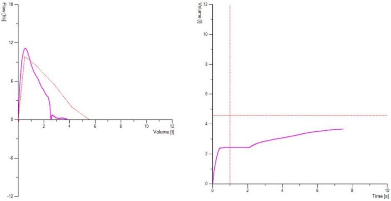 5 Common mistakes when performing Spirometry – Love Medical